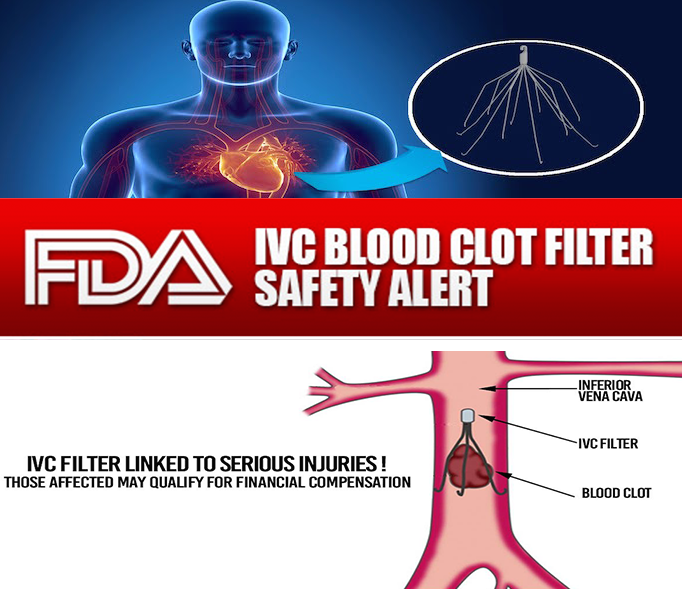 IVC Filter